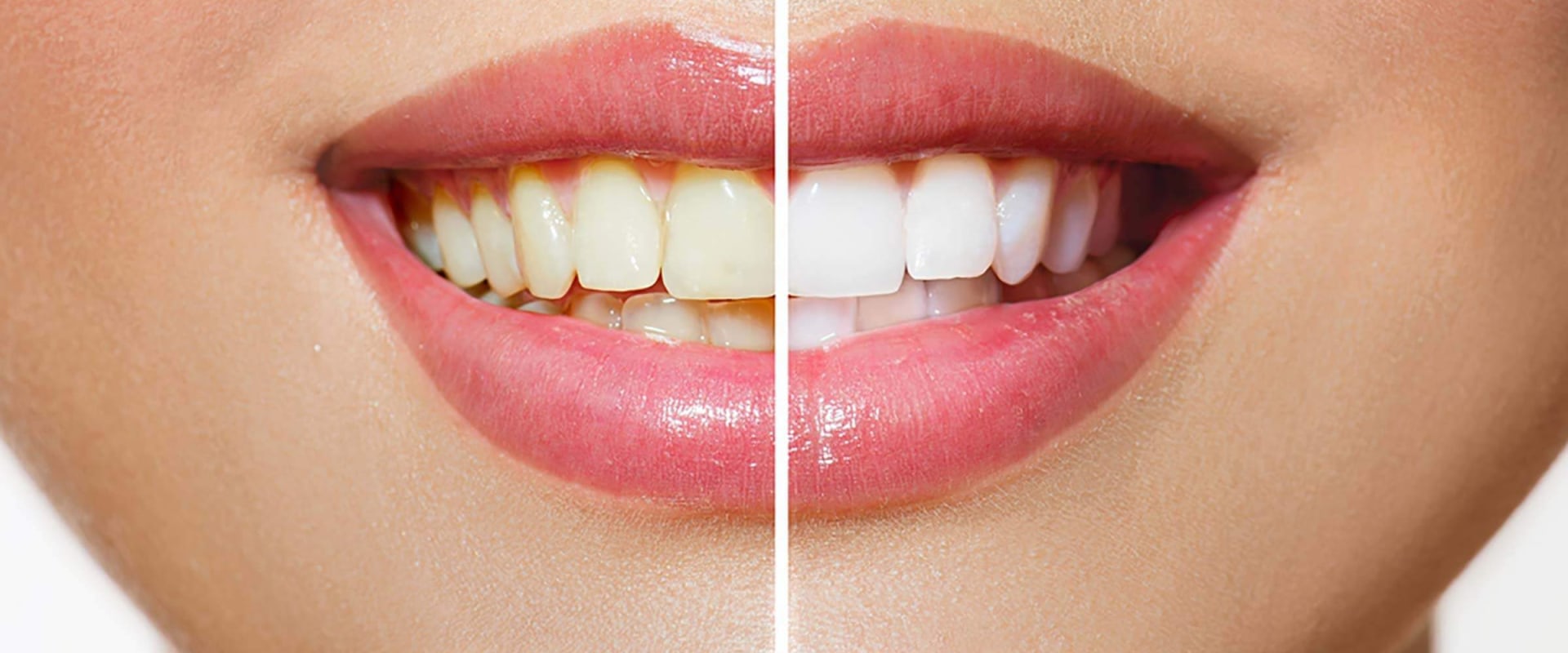 How to Achieve a Perfect White Smile with Teeth Whitening